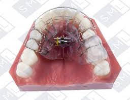 Arch Expansion for Adults: Improve Function & Aesthetics